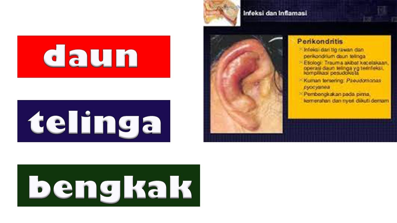 DAUN TELINGA BENGKAK ||PERIKONDRITIS - YouTube