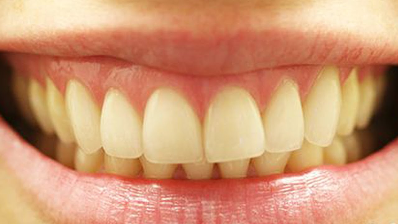 Como é Usar 1 Ano a Mesma Prótese Dentária Removível PPR Parciais ...