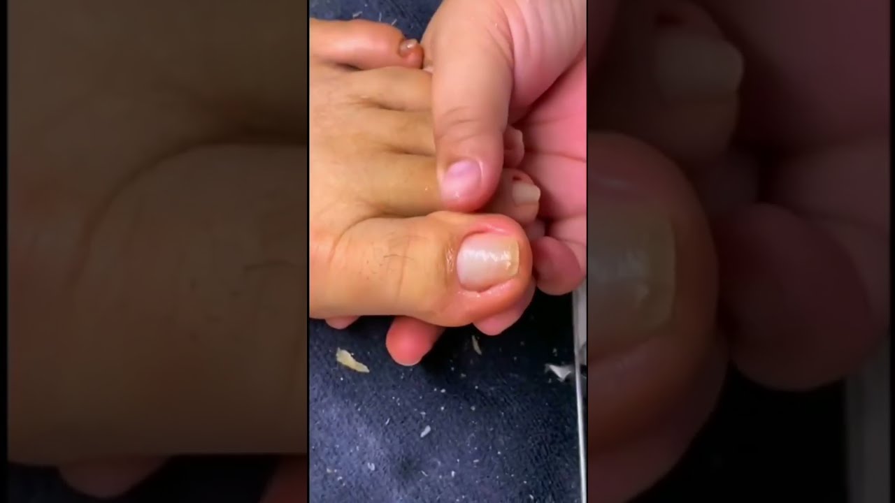 How to cut nails to remove flesh without swelling. #55 - YouTube