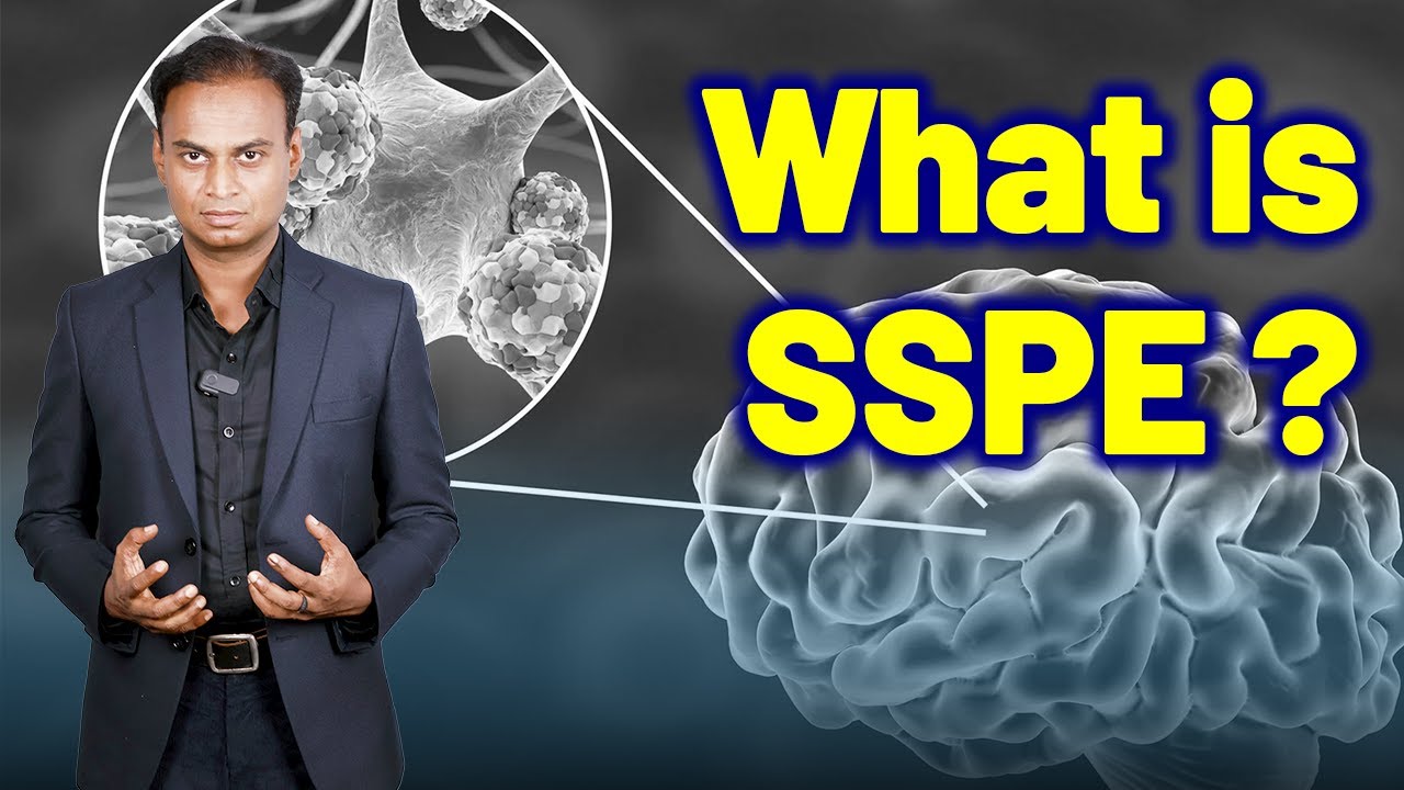 What is SSPE? or Subacute Sclerosing Panencephalitis or Dowson Rare ...