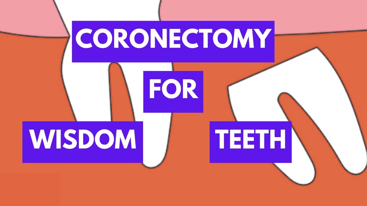 Coronectomy - Alternative Method to Remove Impacted Mandibular Third ...
