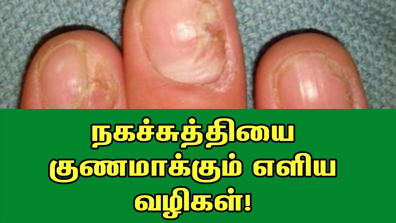 நகச்சுத்தியை குணப்படுத்த உதவும் எளிய வீட்டு வைத்தியங்கள்! Naga suthi ...
