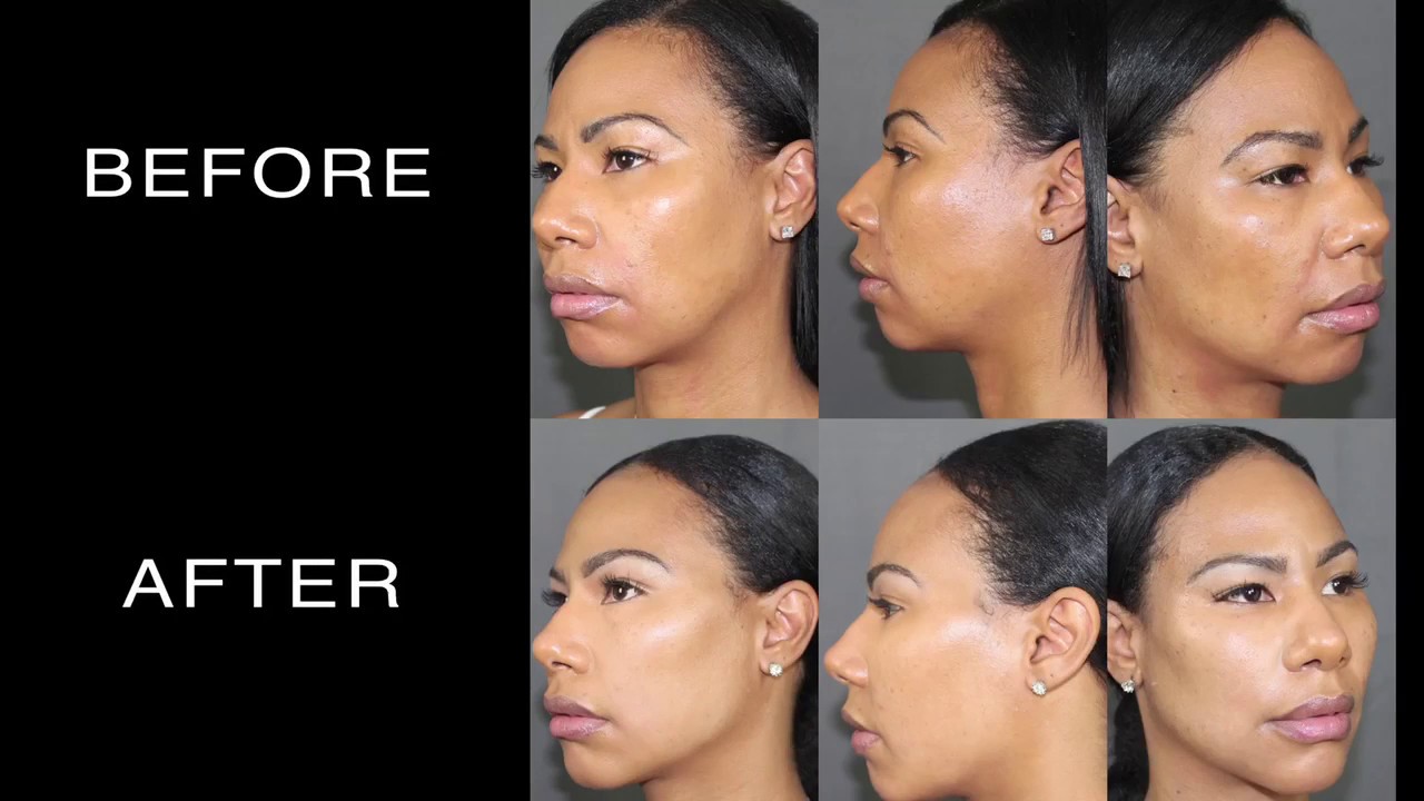 Liquid Facelift with Dermal Filler with Dr. Alex Khadavi - YouTube