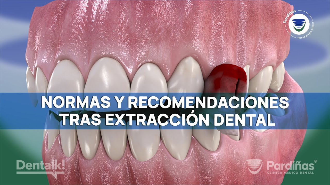 GUÍA completa tras EXTRACCIÓN dental - Evita complicaciones con estos ...