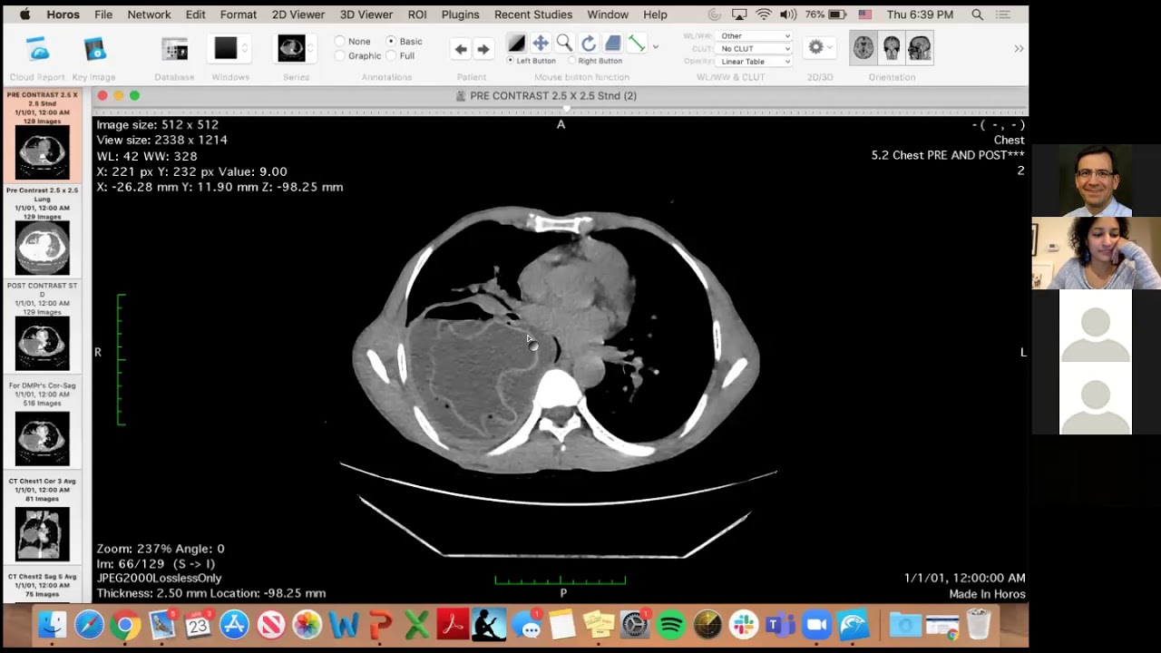 Liver and lung cysts with water lily sign - diagnosis? Dr. Omar Kallas ...