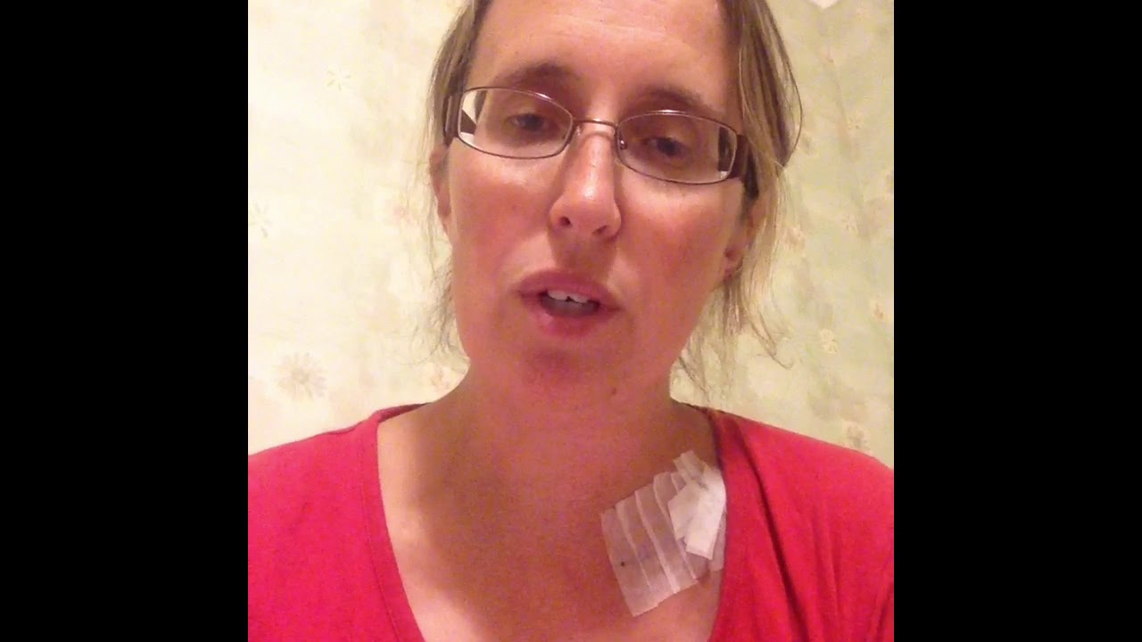 Thoracic OUTLET SYNDROME - Day 10 After Cervical RIB REMOVAL - YouTube