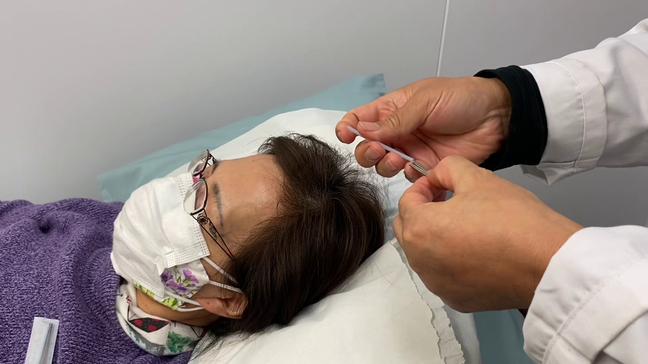 Acupuncture for Insomnia - YouTube