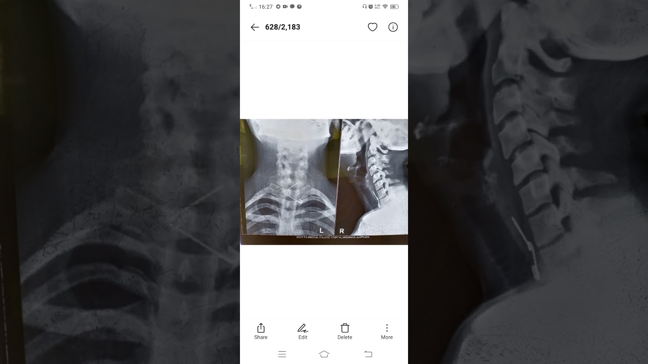 X Ray soft tissue neck AP and Lateral view safety pin - YouTube