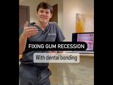 Fixing Gum Recession with Dental Bonding