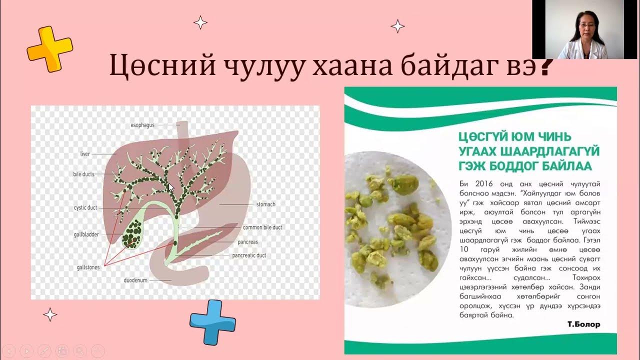 Цөсний чулуу үүсэхээс яаж сэргийлэх вэ Youtube