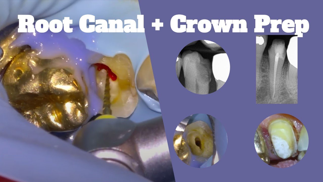 [116] Live Root Canal + Crown Prep - YouTube