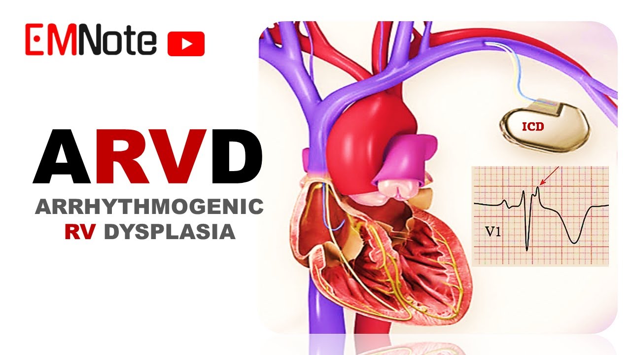 Arrhythmogenic Right Ventricular Dysplasia (ARVD) - YouTube