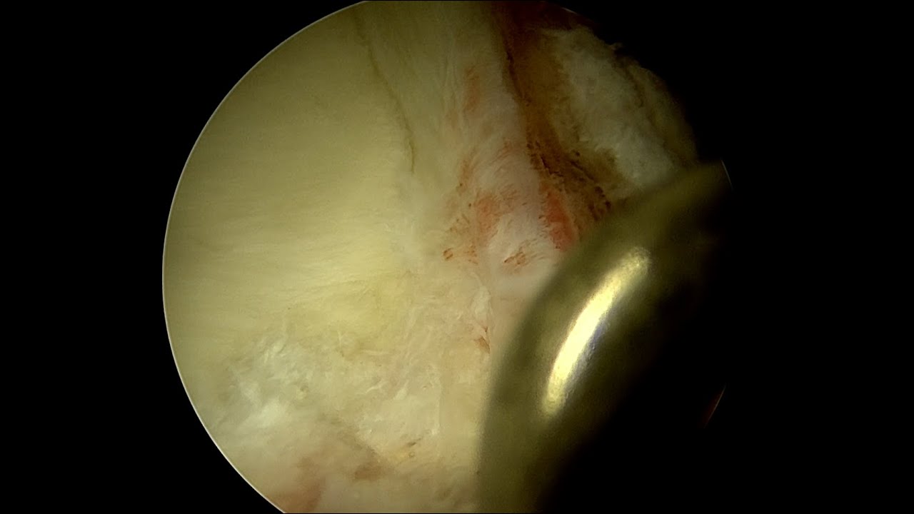 Previously Repaired Labrum with Multiplanar Grade 3 Complexity - YouTube