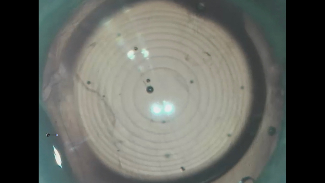 Posterior Capsulorhexis with the Symfony Lens. Narrated by Shannon Wong ...