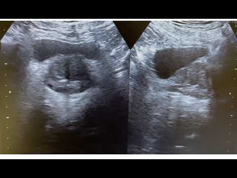 Ultrasound of Acute prostatitis - YouTube