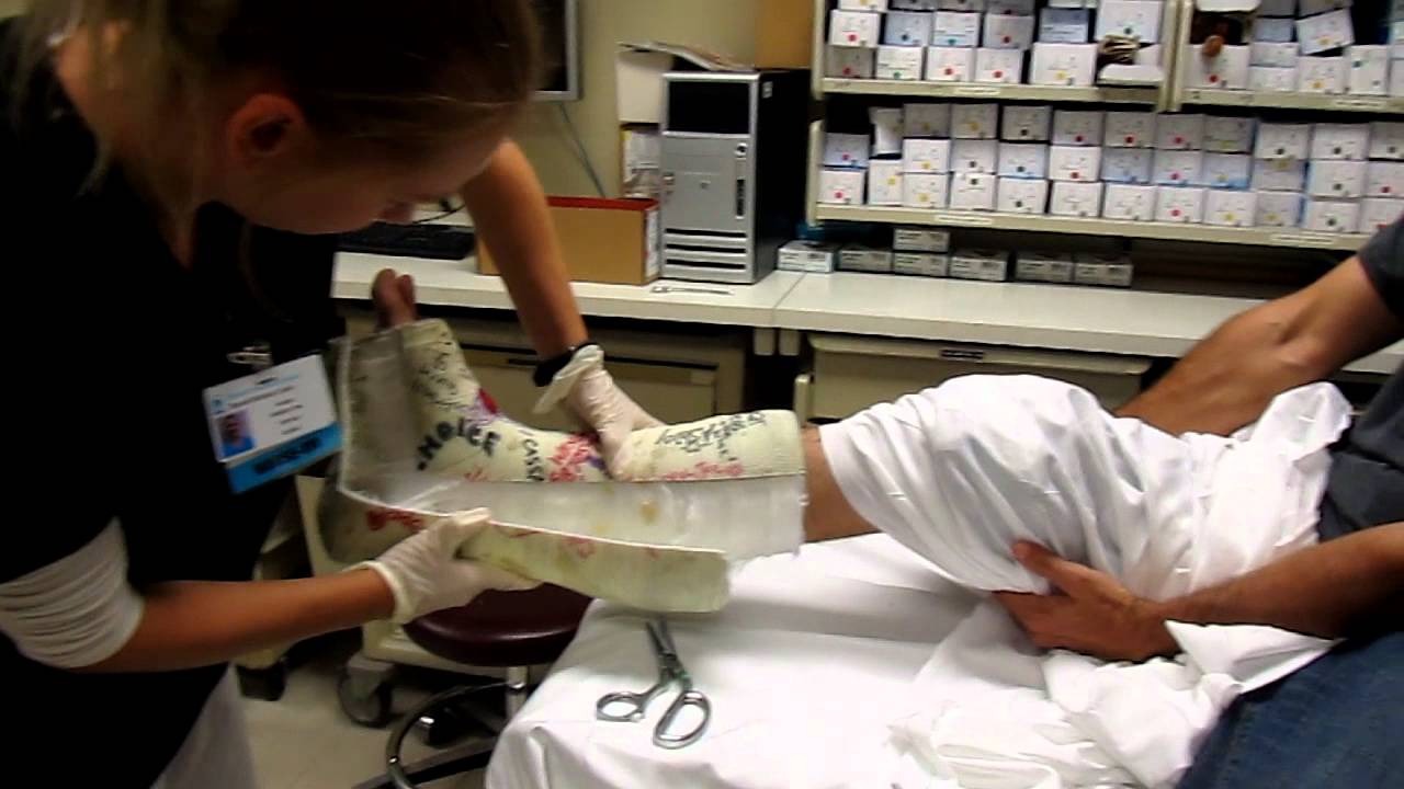 Joe's cast getting taken off - YouTube
