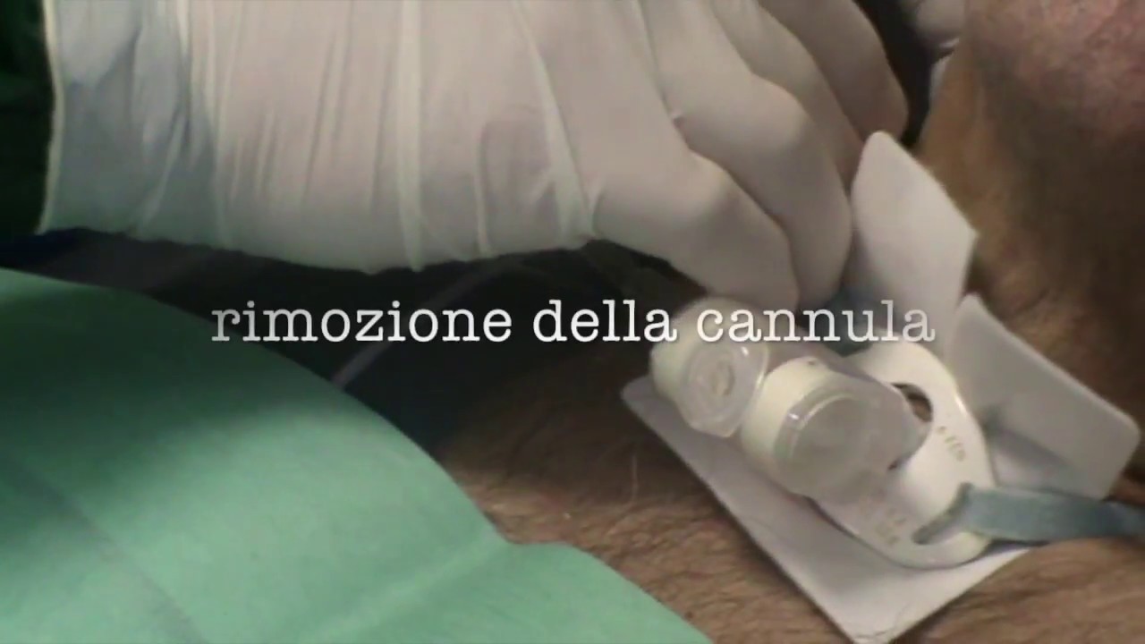 Reparto di UTIR - (3° Official Video CSE) - Sostituzione della Cannula ...