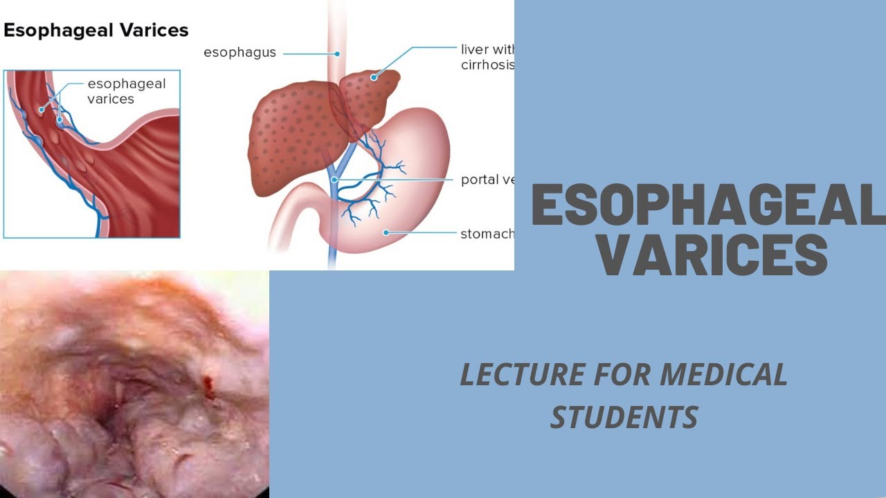 Esophageal Varices - Lecture for Medical Students #mbbs #neet #usmle # ...