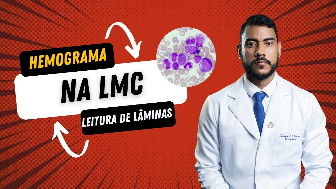 Hemograma Na Leucemia Mieloide Crônica ( LMC) - YouTube