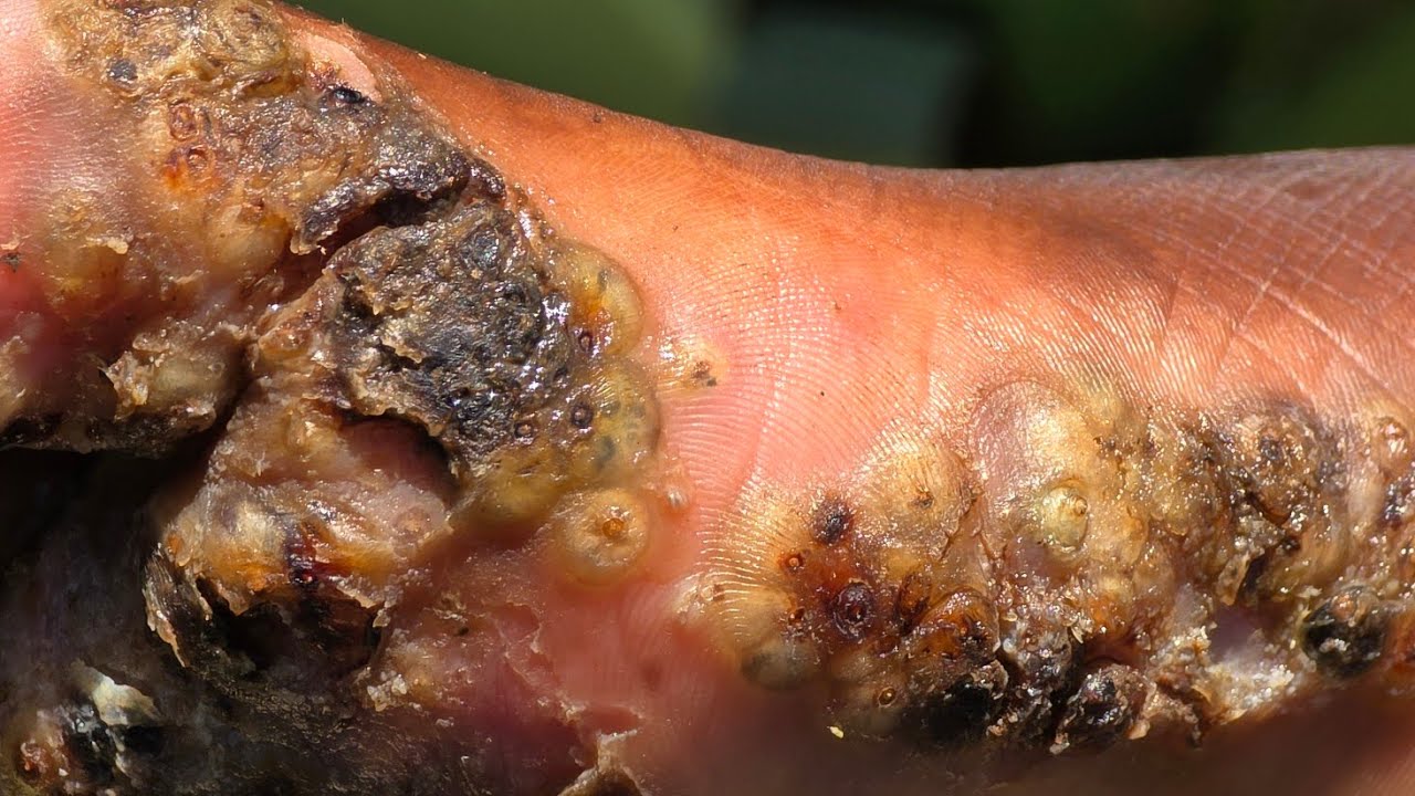 Cosmas' jigger removal - 2nd MOST JIGGERED #1 --- long videos ...