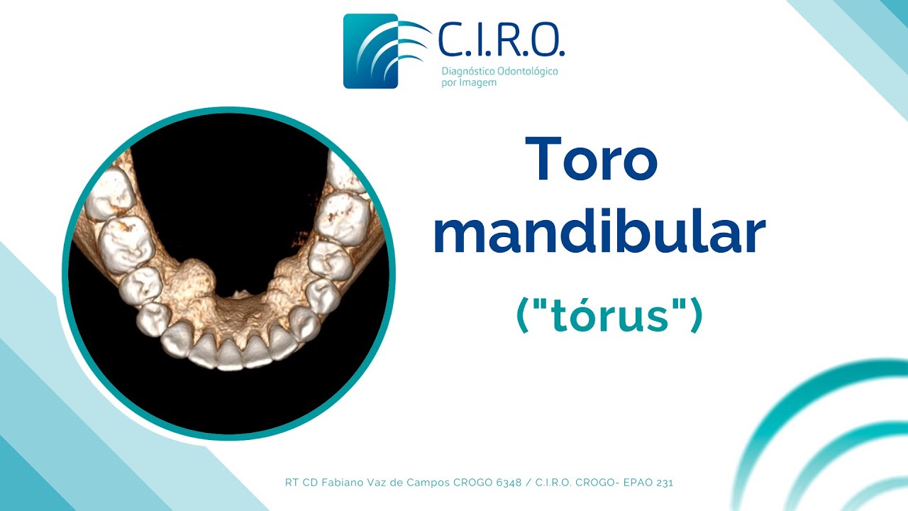 Toro mandibular - YouTube
