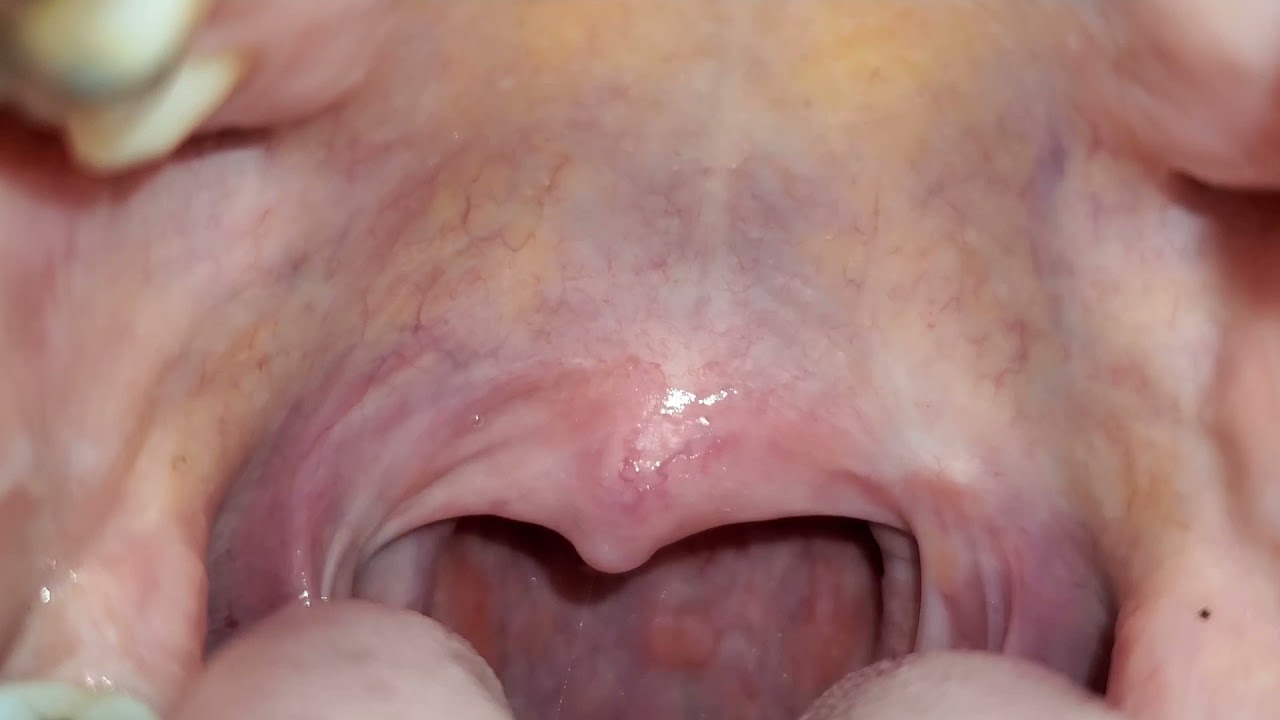 A.S.M.R - P.O.V GLOSSY UVULA EXAM - YouTube