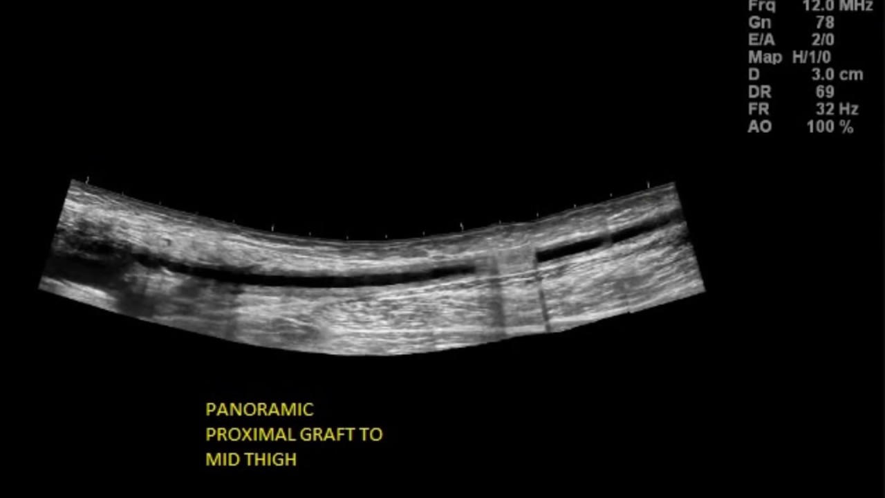 INTIMA HYPERPLASIA IN CFA DPTA GSV GRAFT BYPASS - YouTube