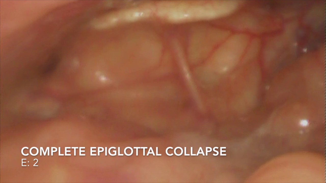DISE epiglottal collapse - YouTube