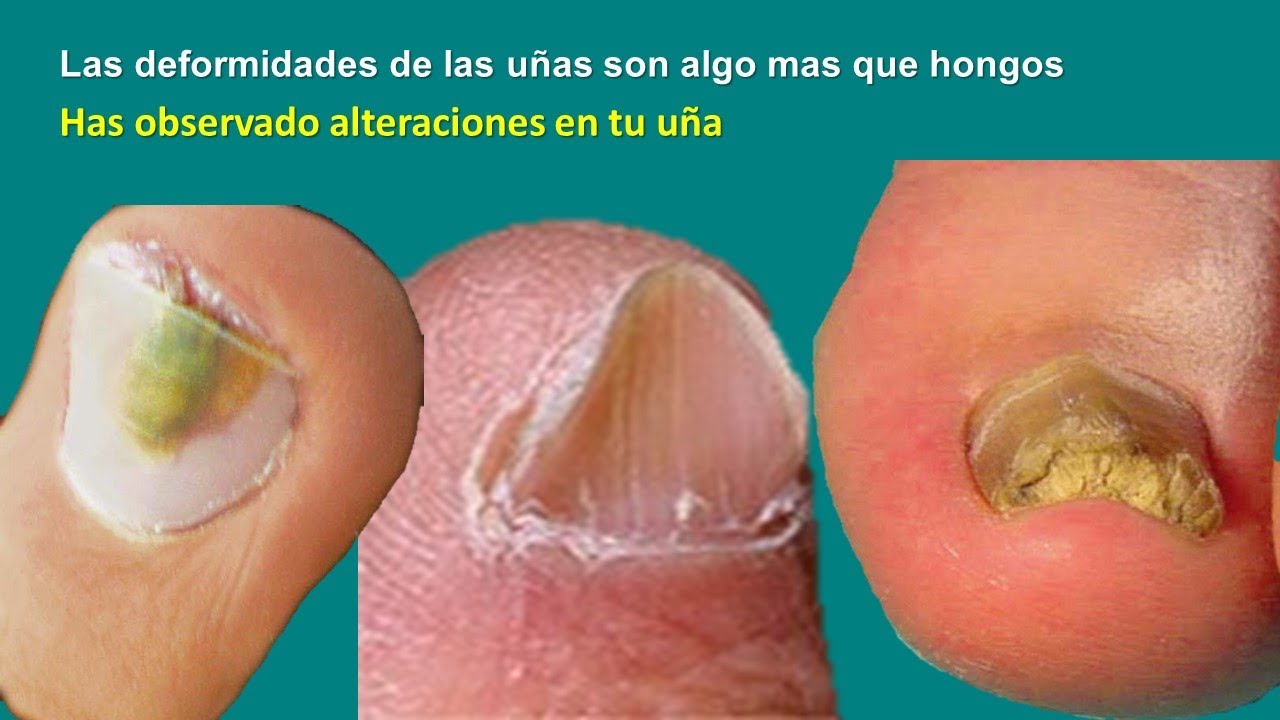 Doctor George, Podólogos Profesionales - Uñas gruesas y hongos - YouTube