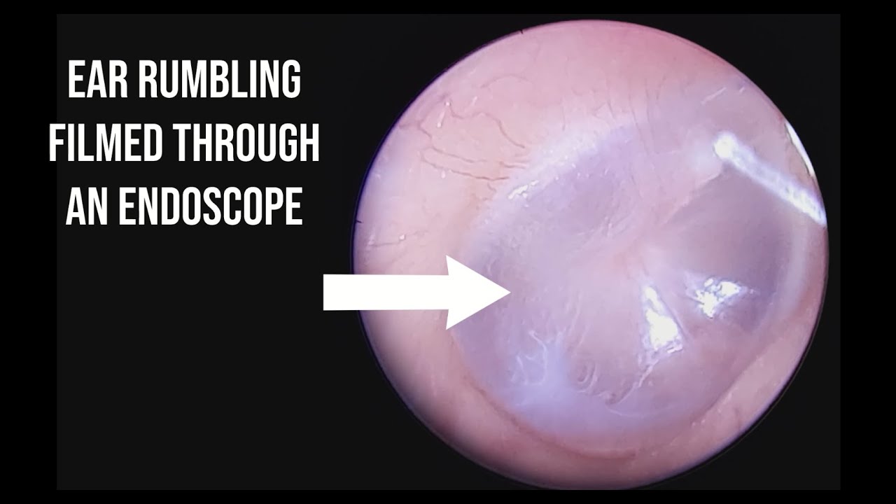 Ear Rumbling Filmed With An Endoscope (Tensor Tympani Muscle) - YouTube