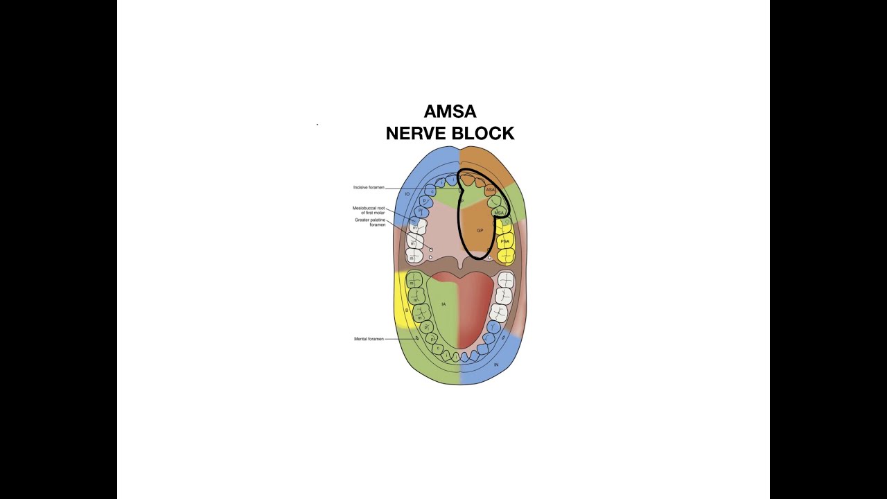 AMSA Left Side Nerve Block Injection - YouTube