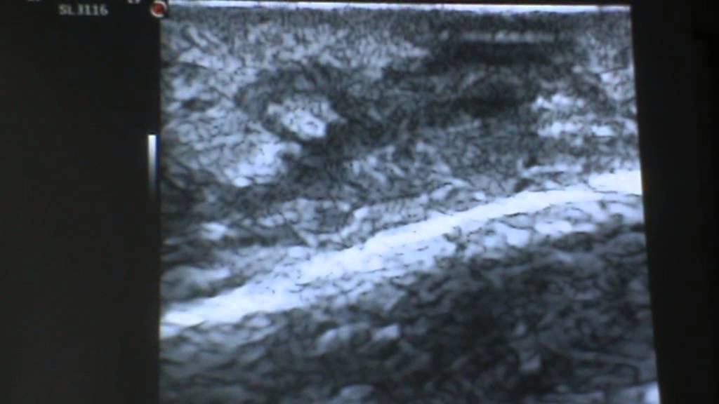 CURSO DE ECOGRAFIA CUTANEA BASICA PARA DERMATOLOGOS - YouTube