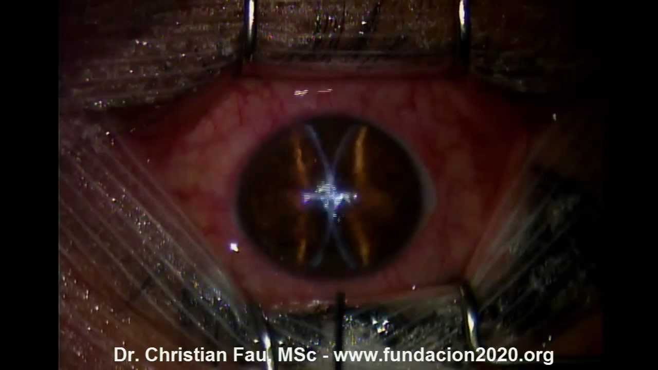 Leucoma Corneal Herpetico - LASEK + Wavefront - YouTube