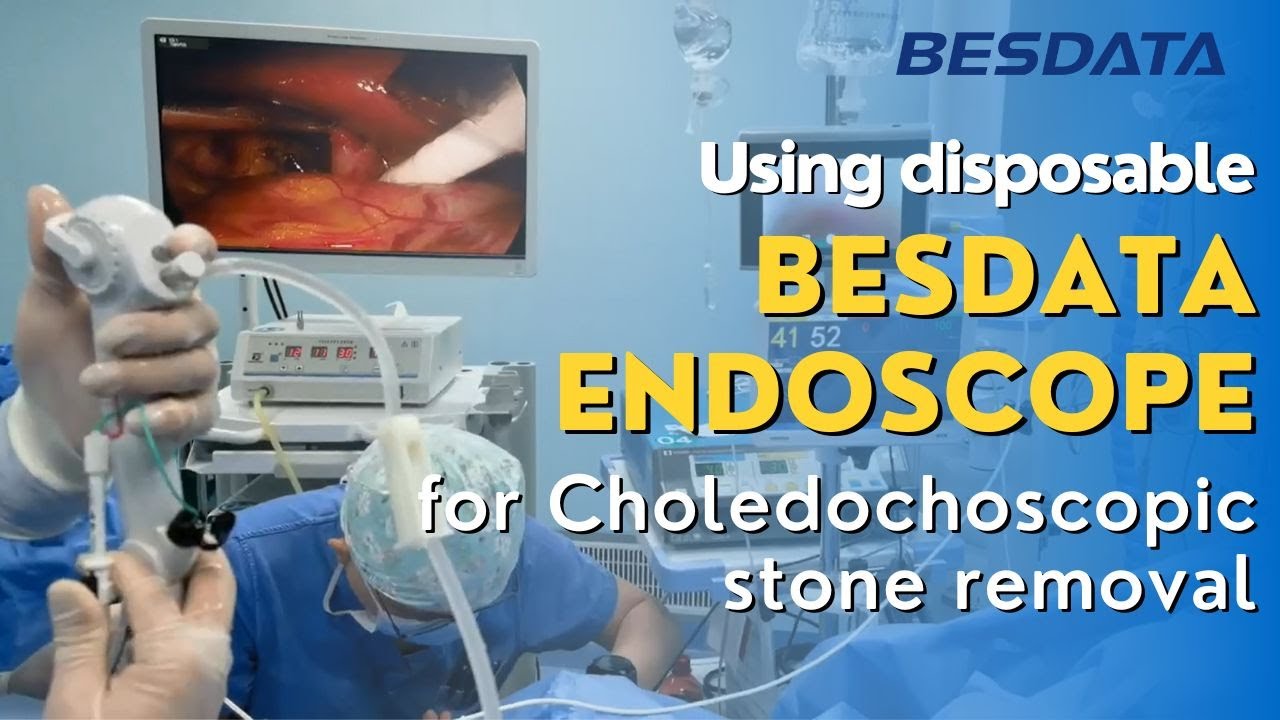 Unmatched Precision: Stone Removal with BESDATA Disposable Flexible ...