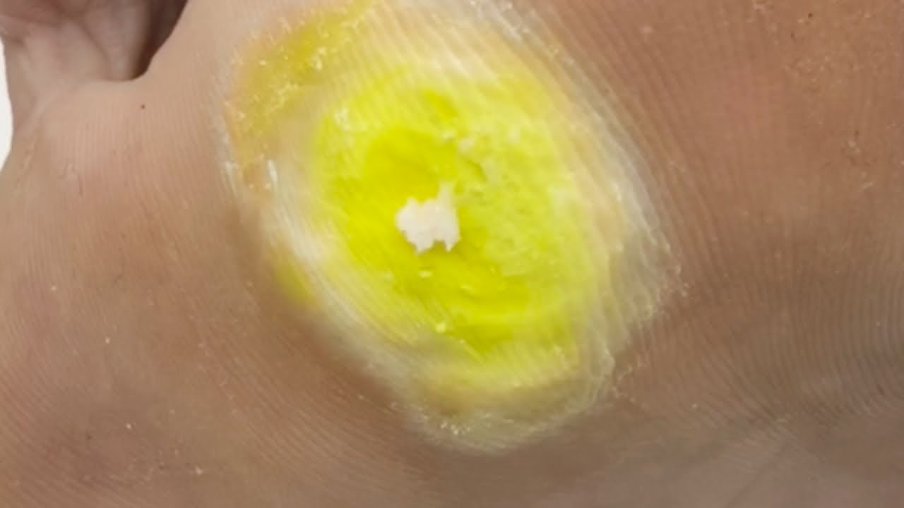 Peeling Off Layers Of Yellow, Dead Skin From The Soles Of The Feet ...