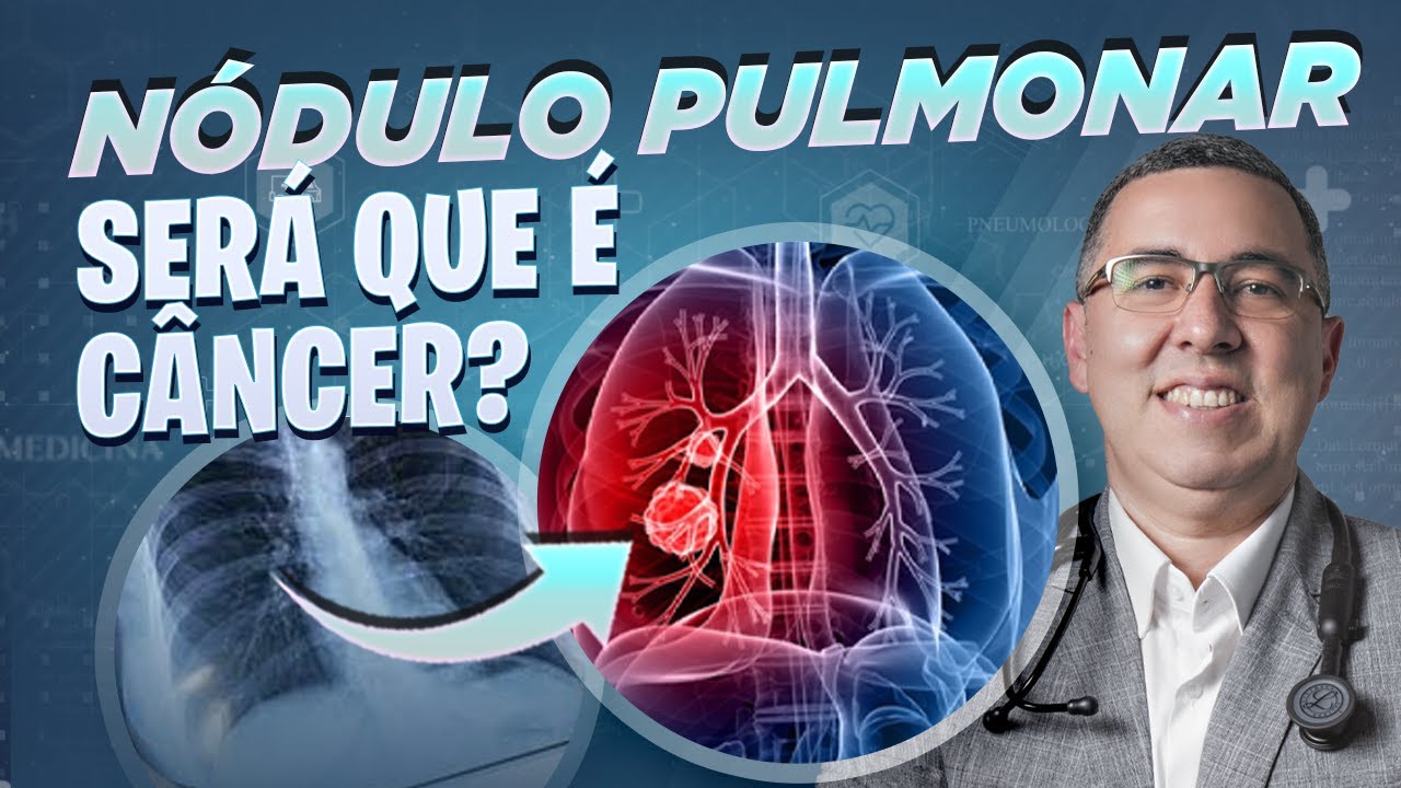 Nódulo no pulmão é câncer? Médico Pneumologista explica o que fazer ...