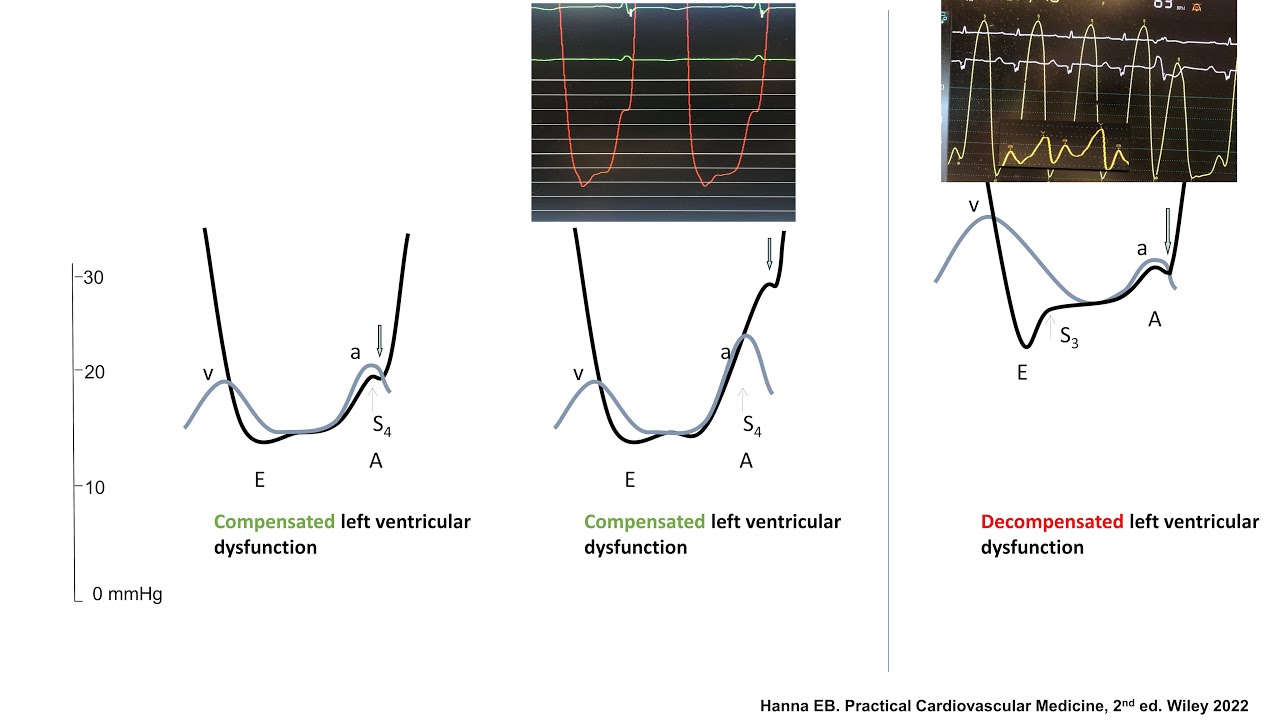 Discrepancies between LVEDP and PCWP- Elias Hanna - YouTube