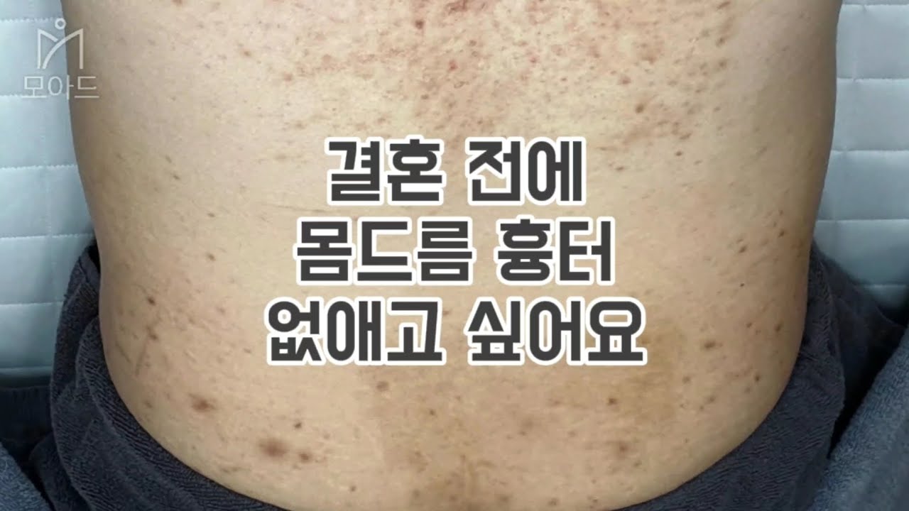 결혼 전에 몸드름 흉터 없애고 싶어요👰🏻 심각할수록 환영합니다🙌🏻 건대 피부관리 모아드 Back Acne Scars