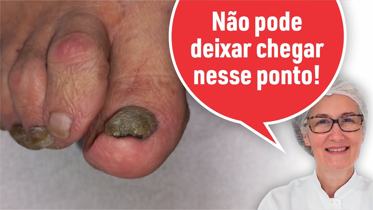 TEM FUNGO EM QUASE TODAS AS UNHAS! - YouTube