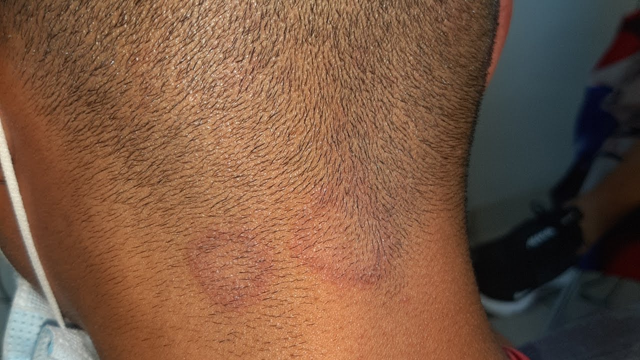 jiotes 100% efectivo una sola cura - YouTube