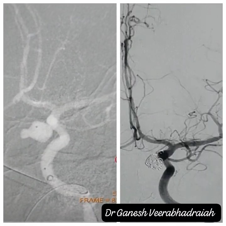 Endovascular Surgery-Coiling of Aneurysm-First coil and Complete ...