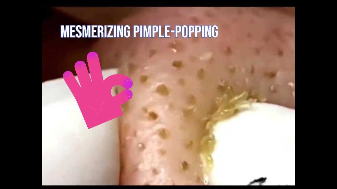 Mesmerizing Blackheads Popping - YouTube