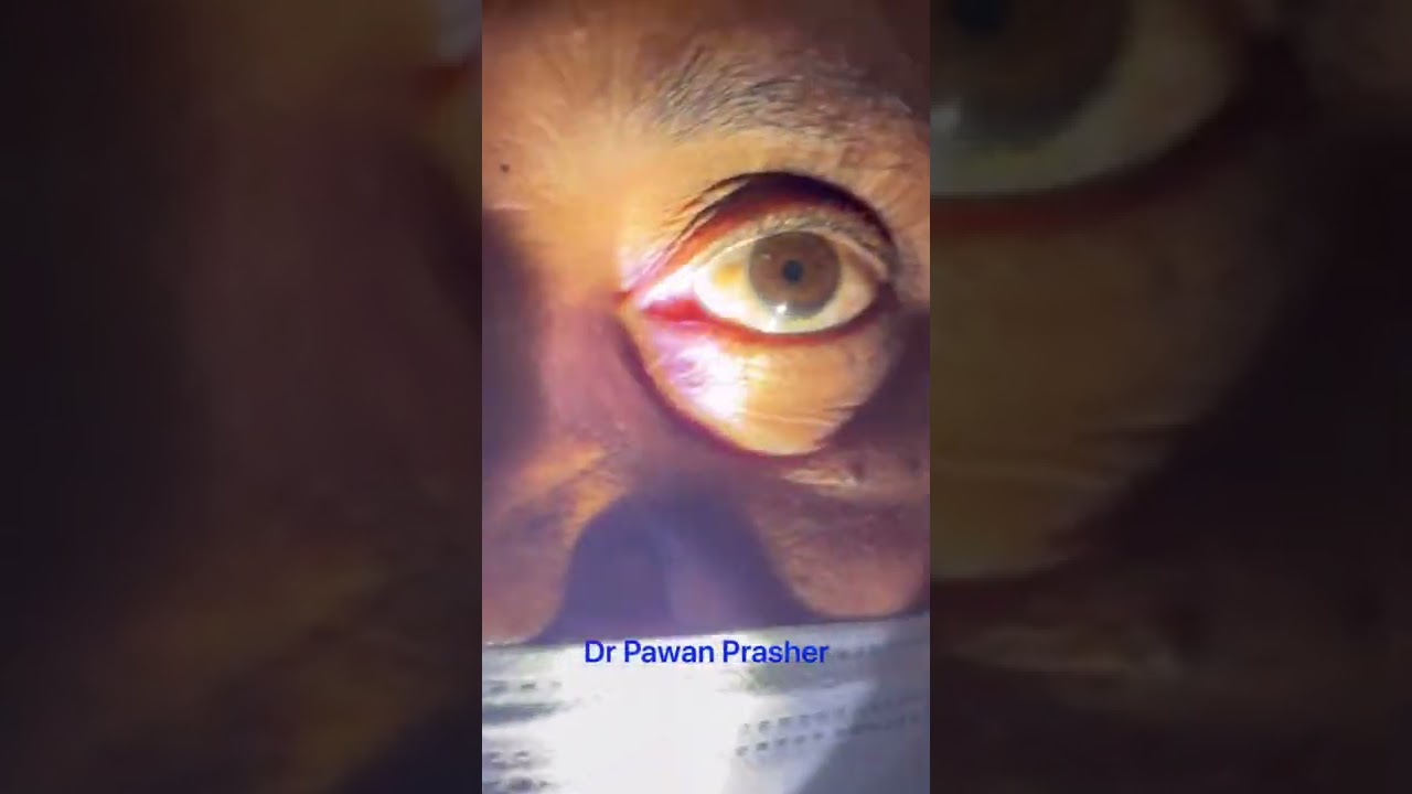 RAPD (Relative Afferent Pupillary Defect) - YouTube