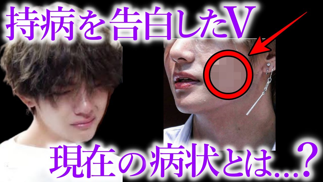 【BTS】Vが涙ながらに告白した､自身の持病の現状がヤバすぎる…【ARMY心配】 - YouTube