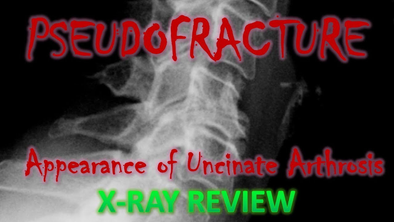 Pseudofracture appearance of Uncinate Arthrosis #radiology #stenosis # ...