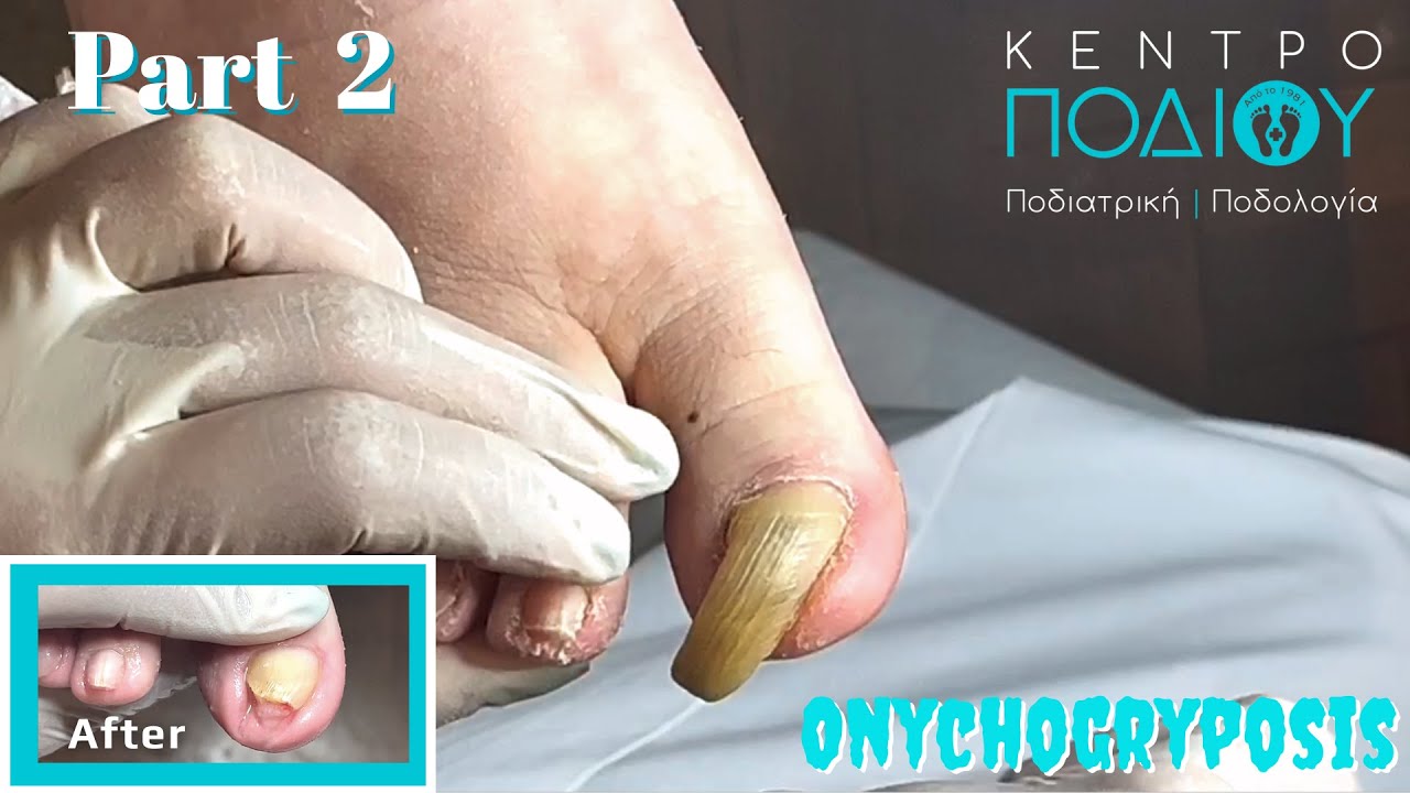 2|Onychocryptosis|Nail problem|Ονυχοκρύπτωση|Κέντρο Ποδιού Podiatry ...