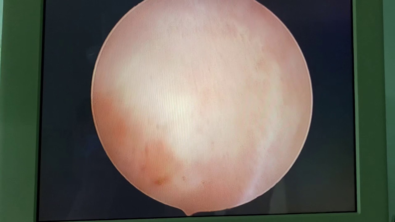 Vaginoscopy by Shawki - YouTube
