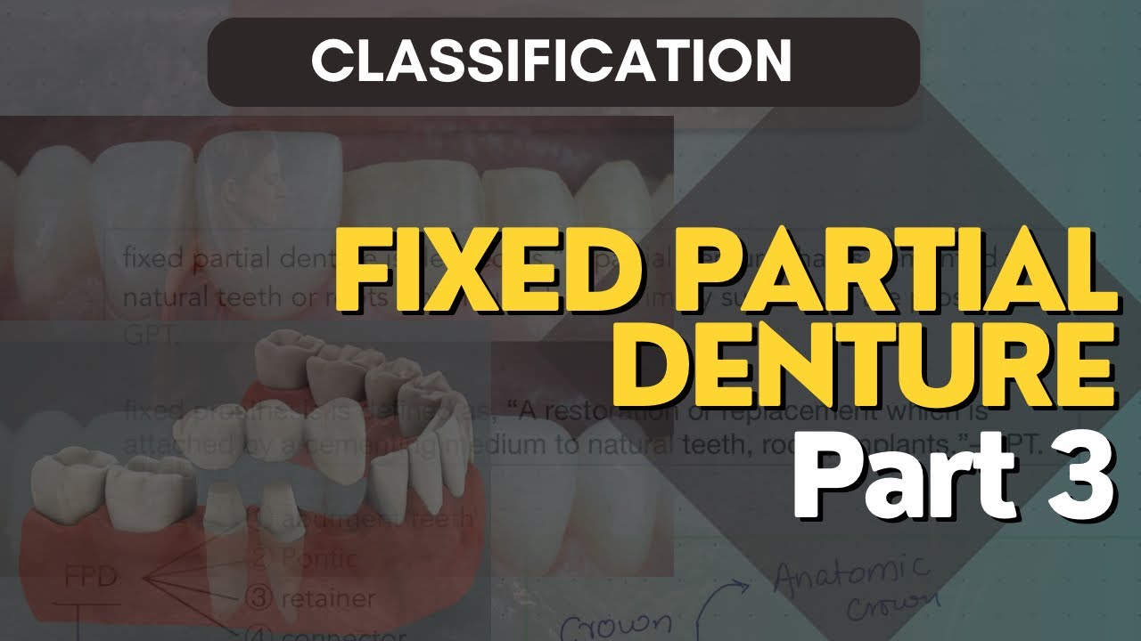 Fixed Partial Dentures classification / Dental videos for student - YouTube