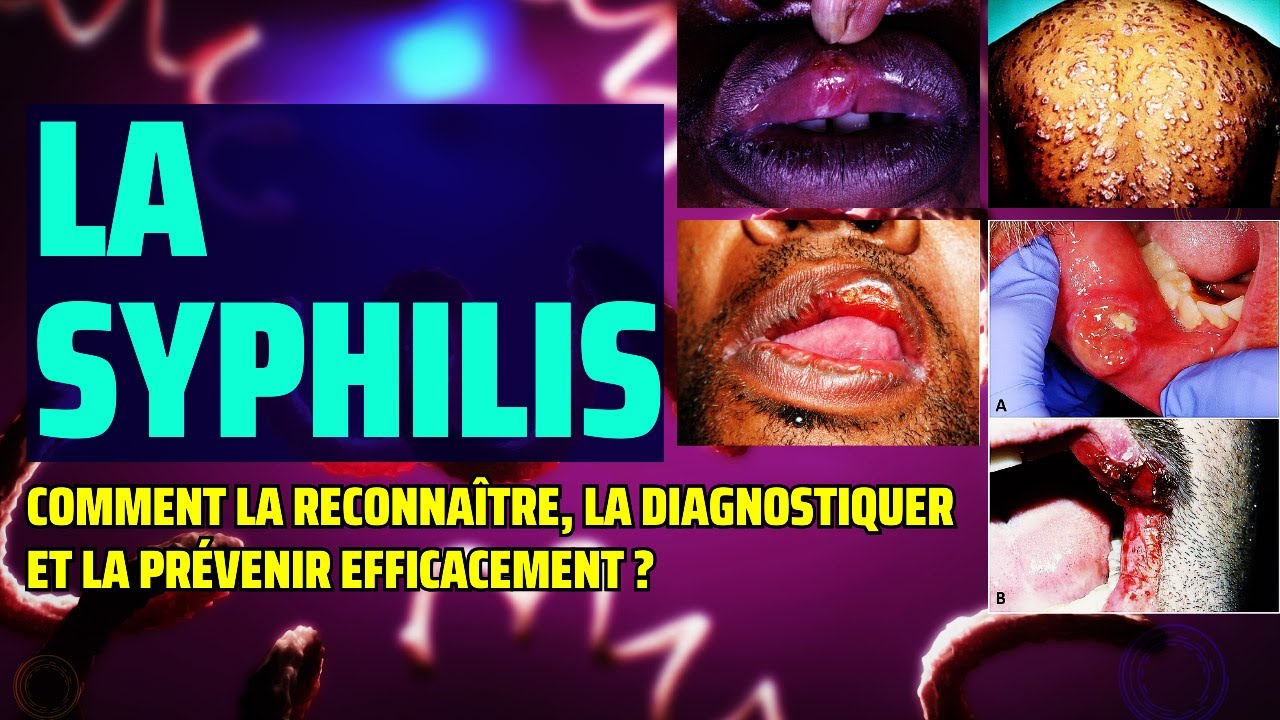 LA SYPHILIS : TOUT SAVOIR SUR - Symptômes, Causes, Prévention et ...