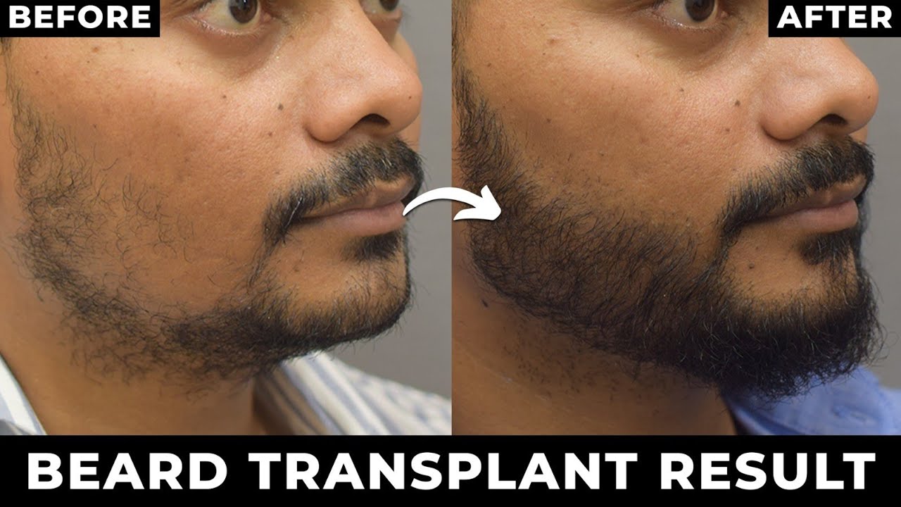 Patchy To Perfect Beard | Beard Transplant Case Study by Dr.Mohd Asif - YouTube